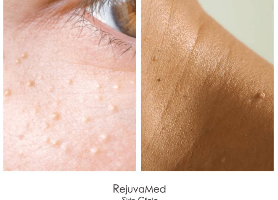 Milia Removal AIDAIMZ 2 Pack 144PCS Milia Remover, Milia Spot